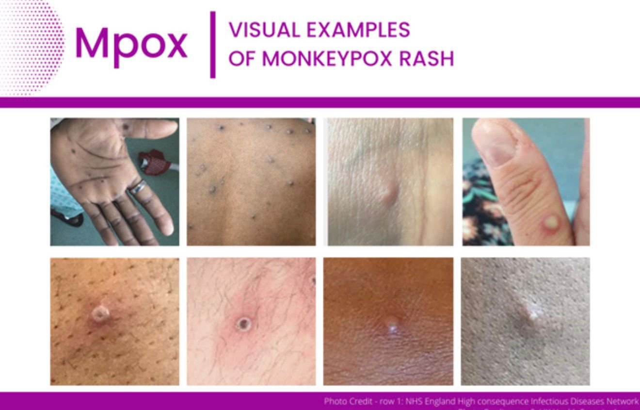 Second Mpox-linked death in Pakistan reported in HIV patient with ...